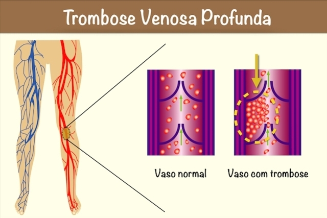 O que é Trombose (TVP), sintomas, cura, tratamento e mais | CR Saúde